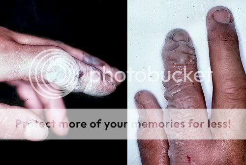 HF Burns To Fingers Photo by mschlags | Photobucket